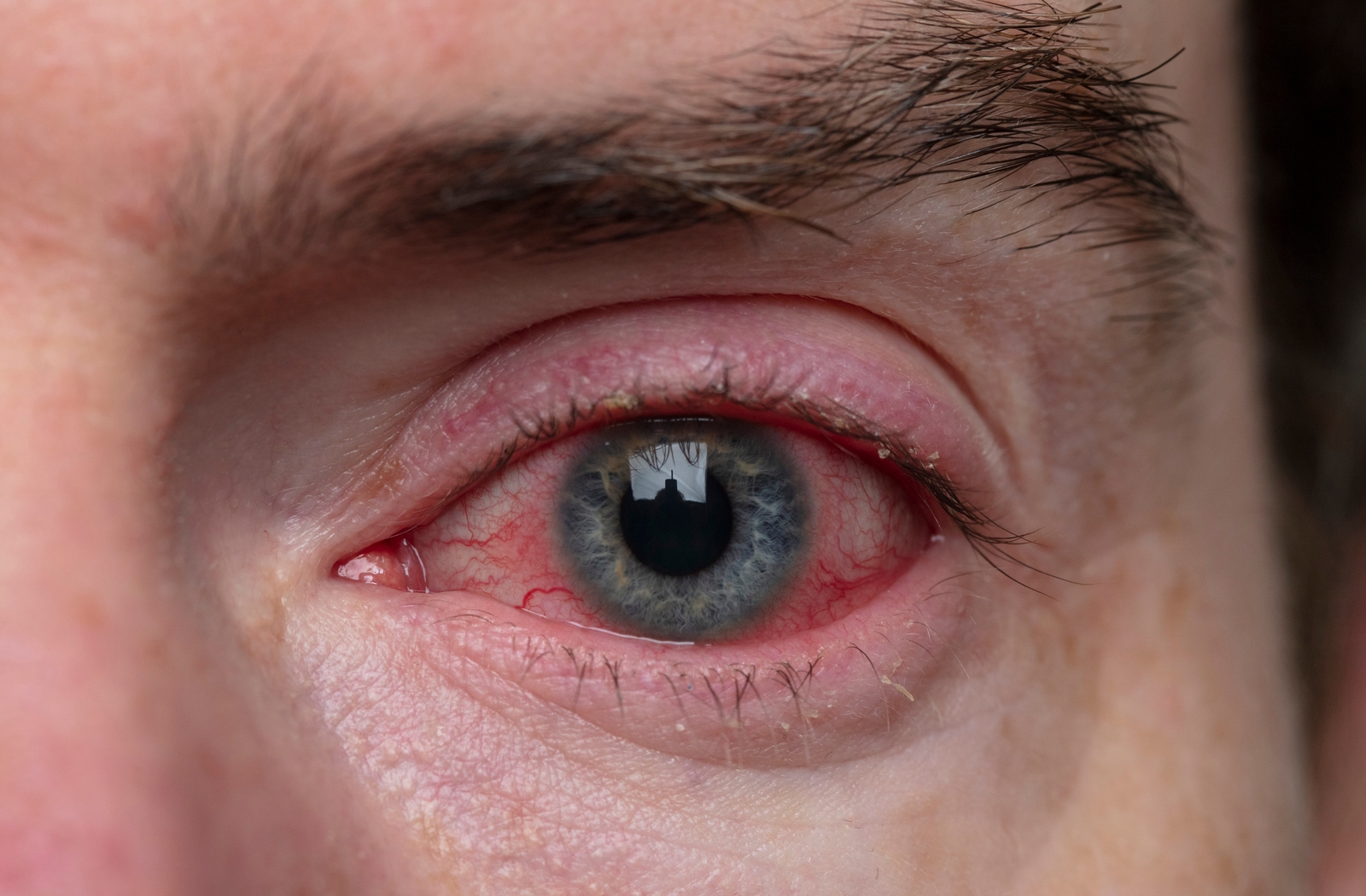 Is Blepharitis And Dry Eye The Same Thing Fort Worth