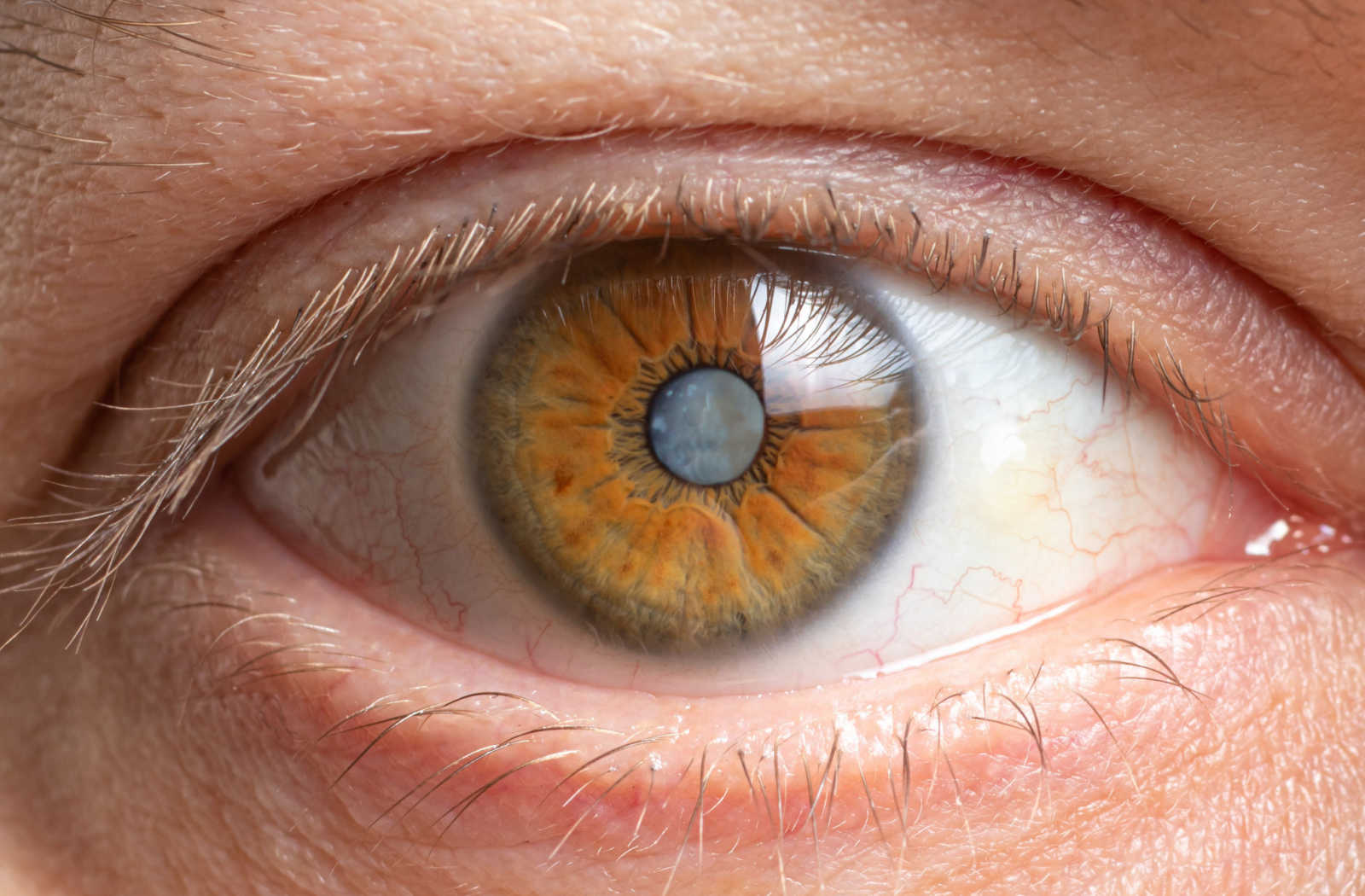 Does Everyone Get Cataracts CHROMA Modern Eyewear Eyecare